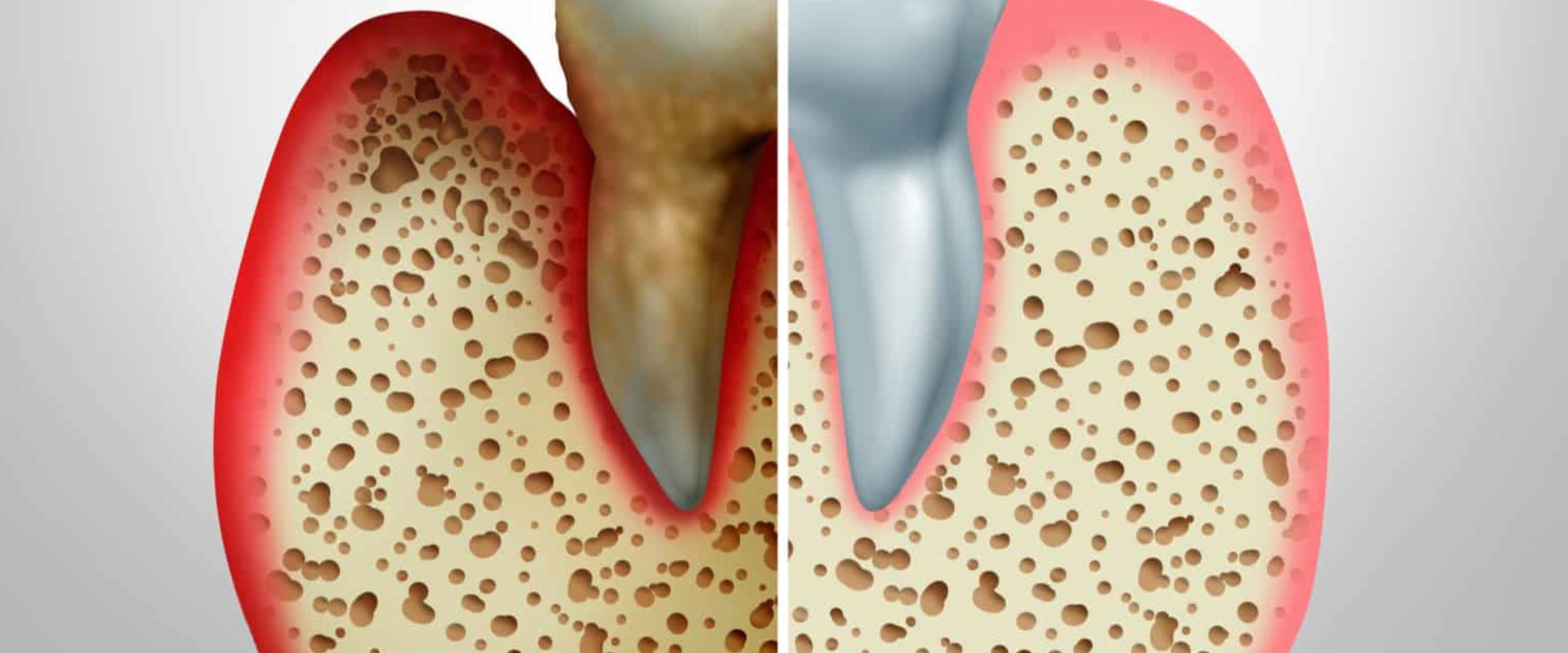 The Impact of Bone Loss on Cheekbone Appearance: Understanding the ...