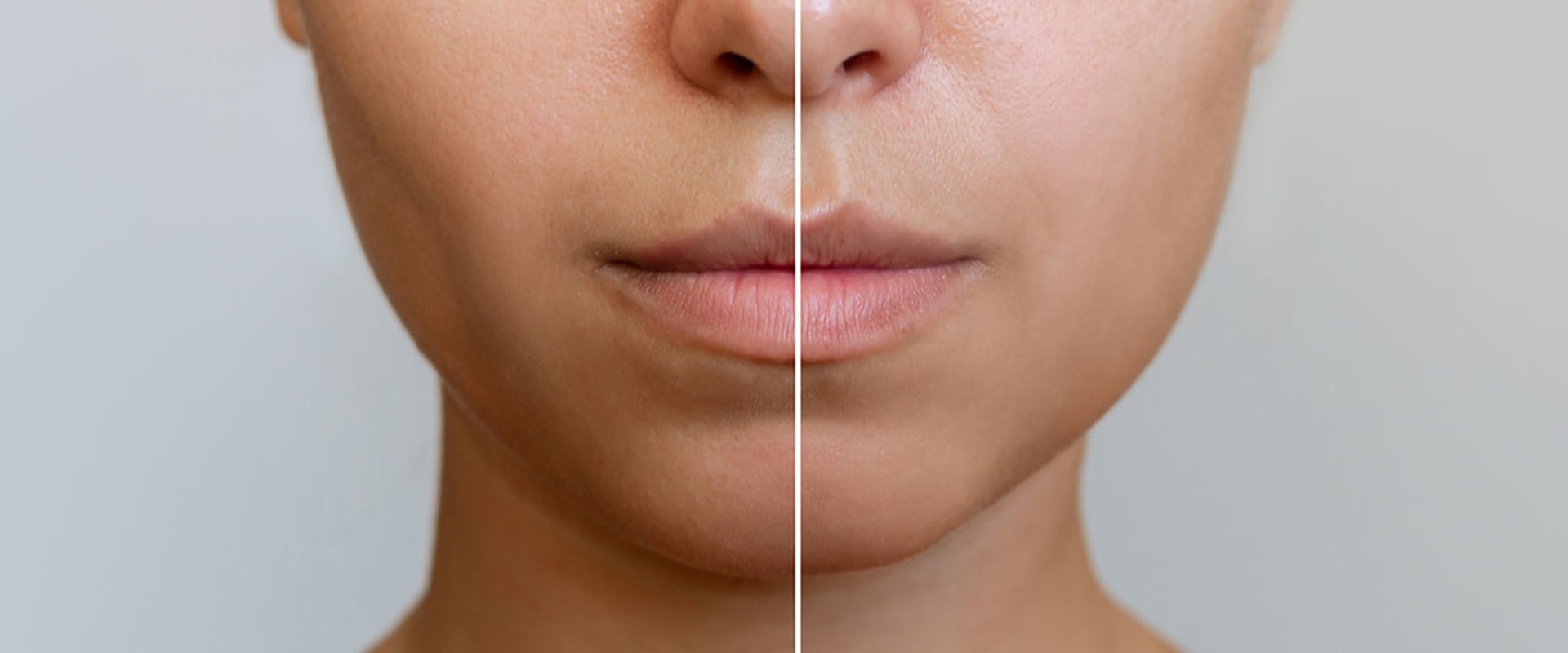 Cheekbone Reduction for a More Refined Appearance - A Comprehensive Guide