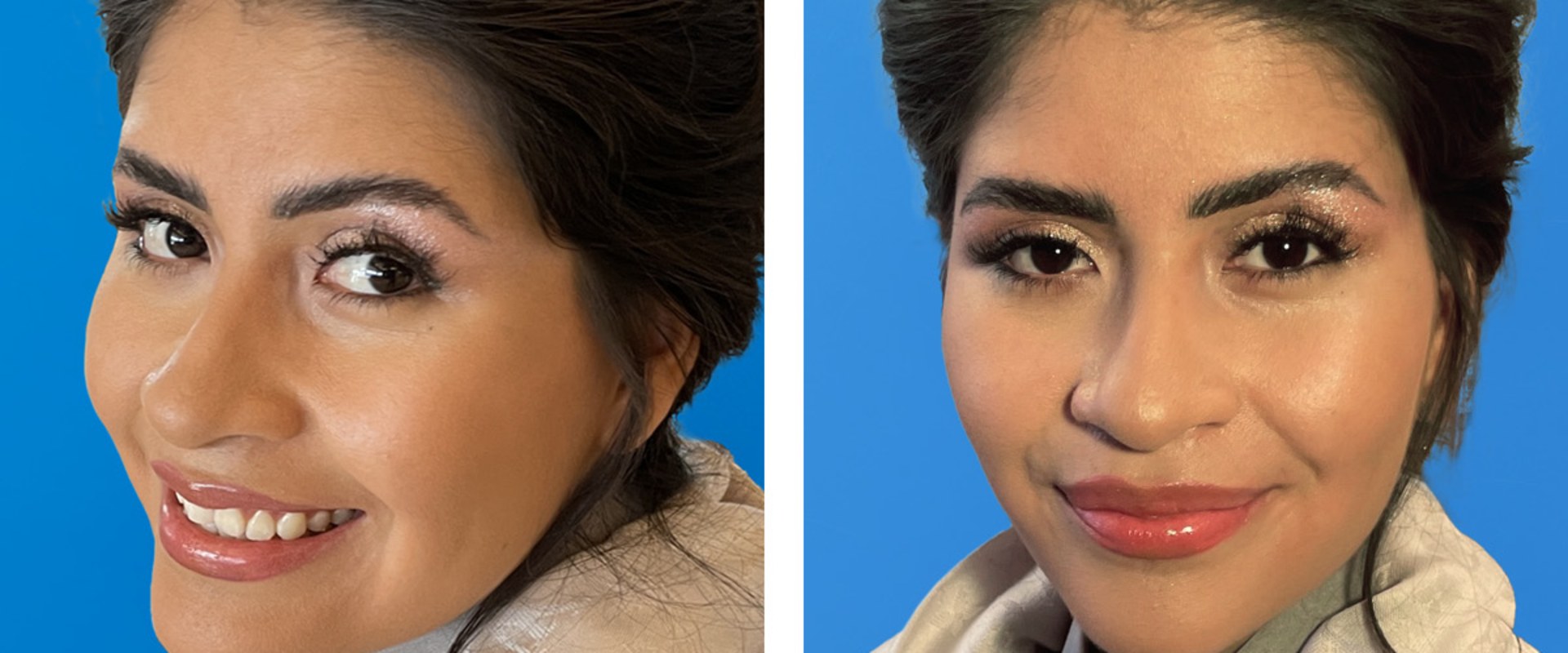 Understanding the Importance of Cheekbones in Facial Appearance